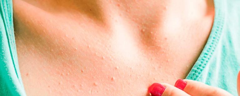 Granos en el pecho: causas y tratamientos efectivos • SaludManía.com